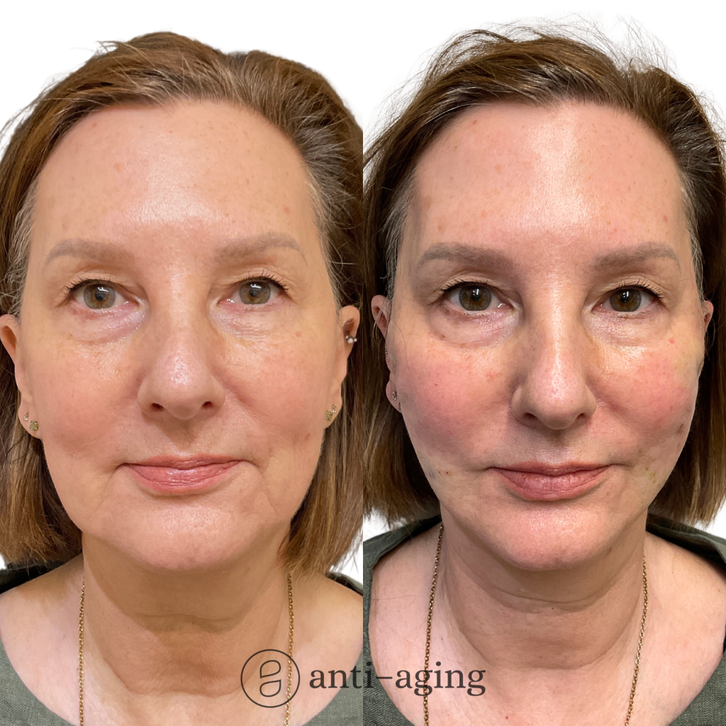 Eliminate UnderChin: Safely Destroy Fat Cells for a Sleek Profile