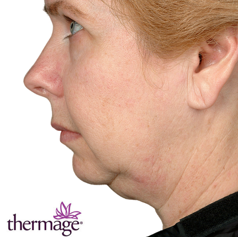 Thermage: Skin Tightening Treatment for a Younger Looking You