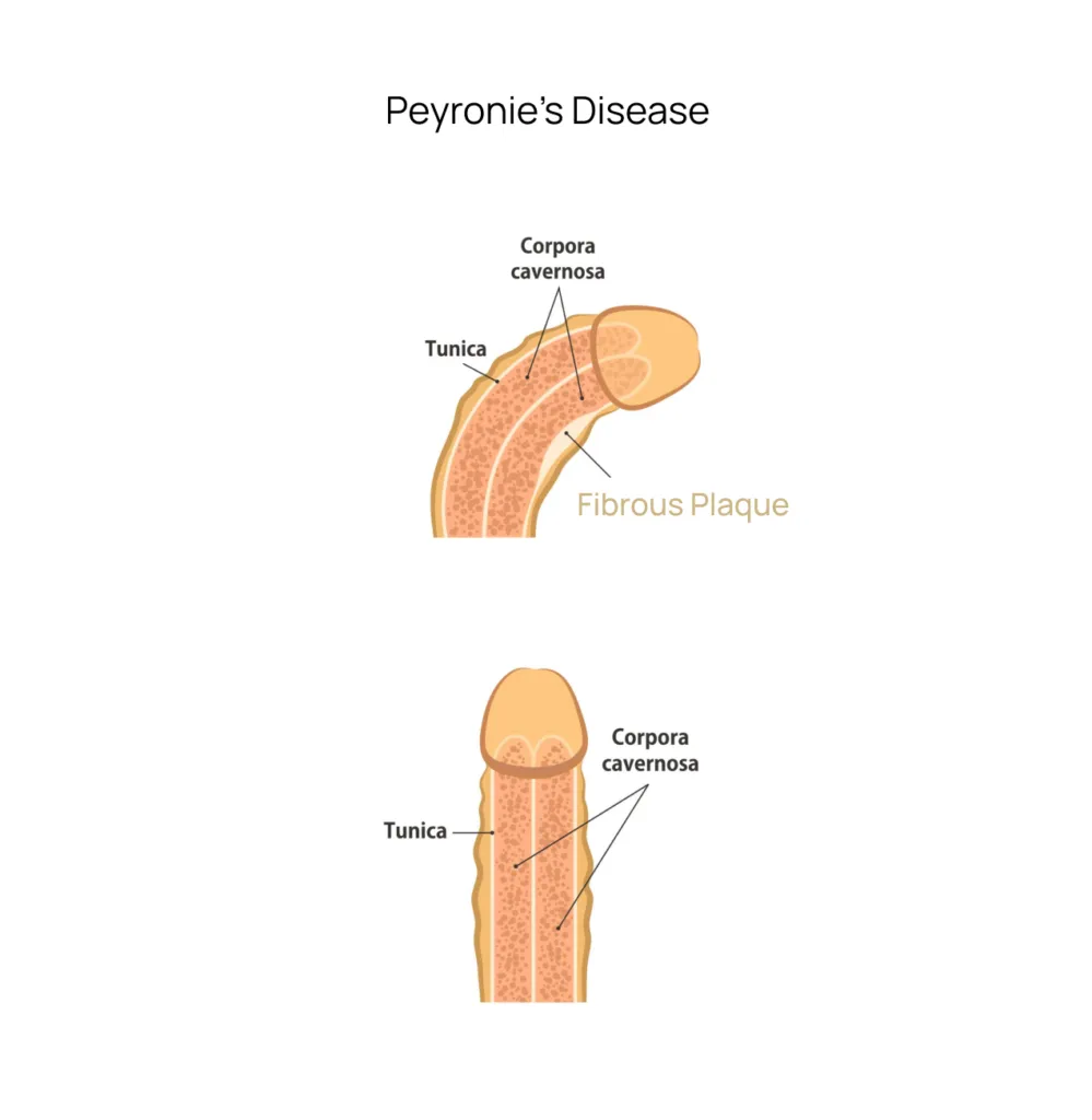Peyronie's Disease: Causes and Management Options