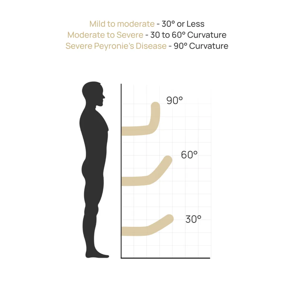 Peyronie's Disease: Causes and Management Options